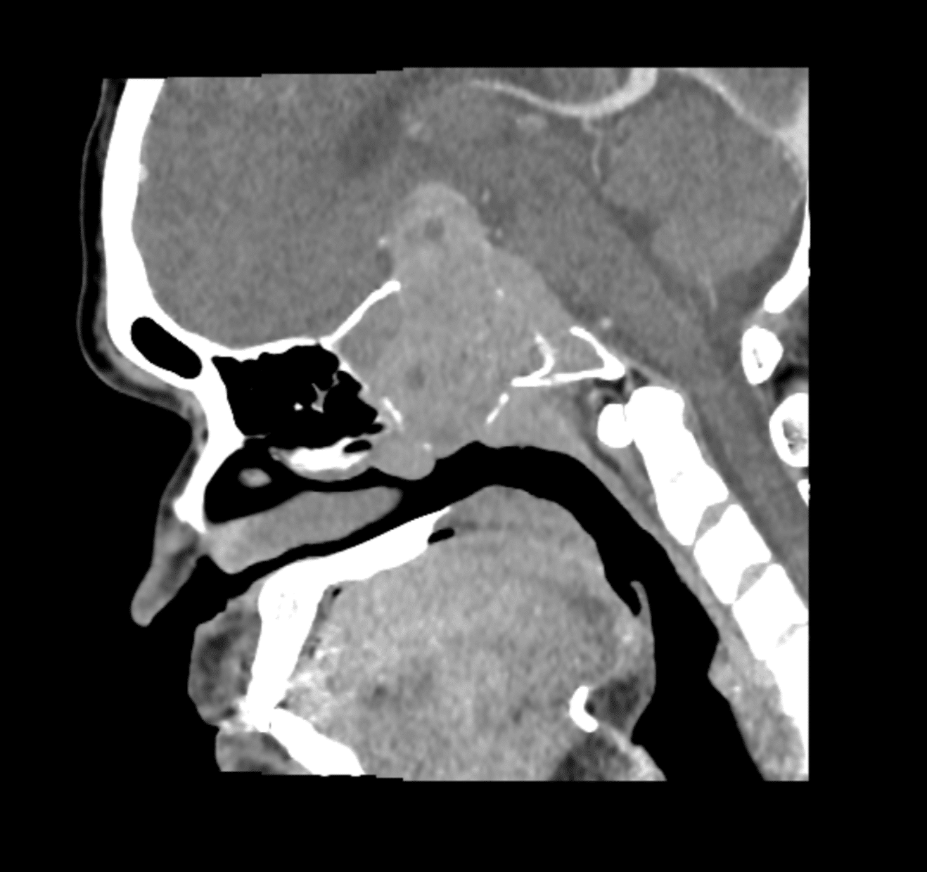 CT Case 065 • LITFL • CT scan interpretation