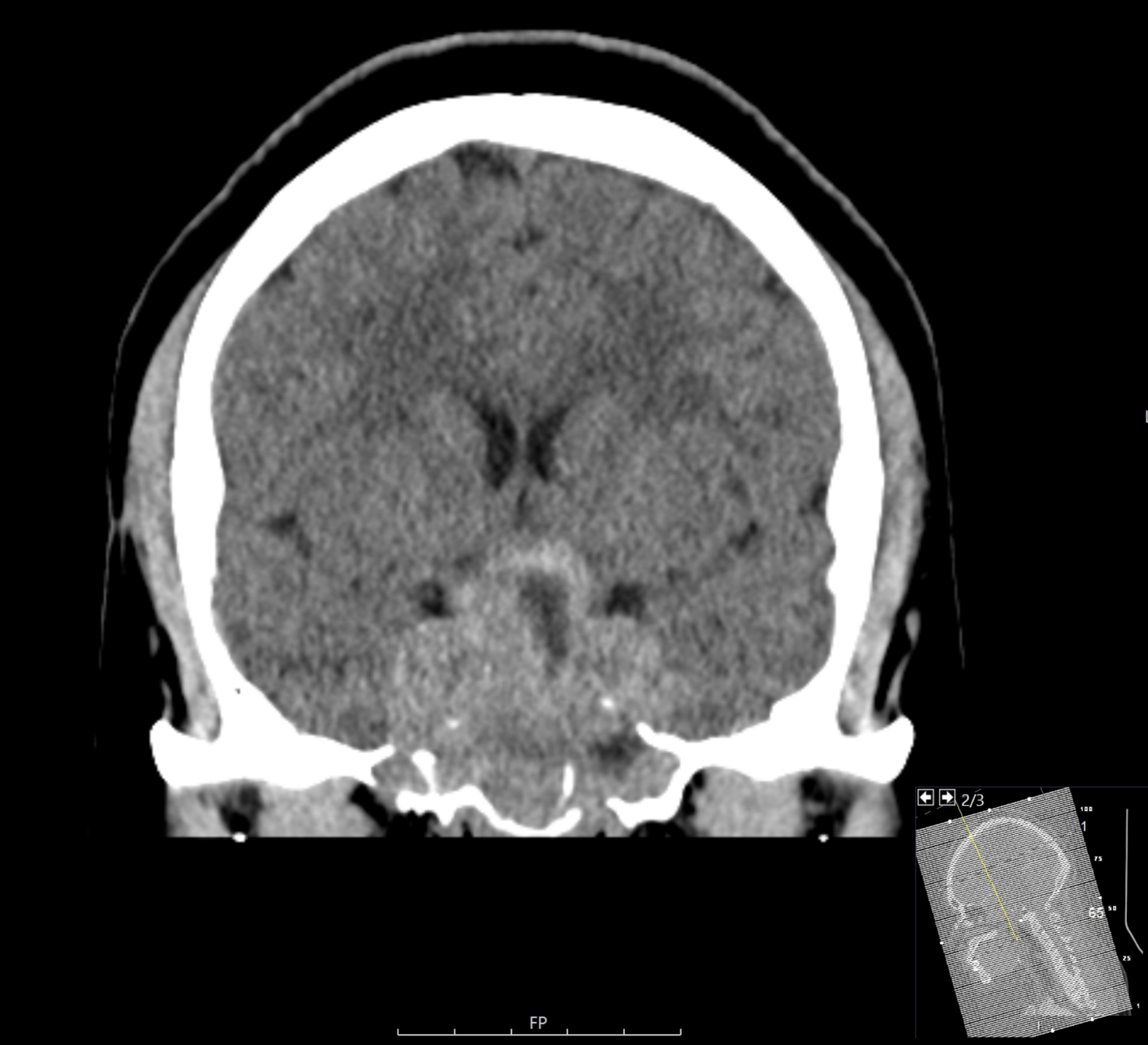 CT Case 065 • LITFL • CT scan interpretation