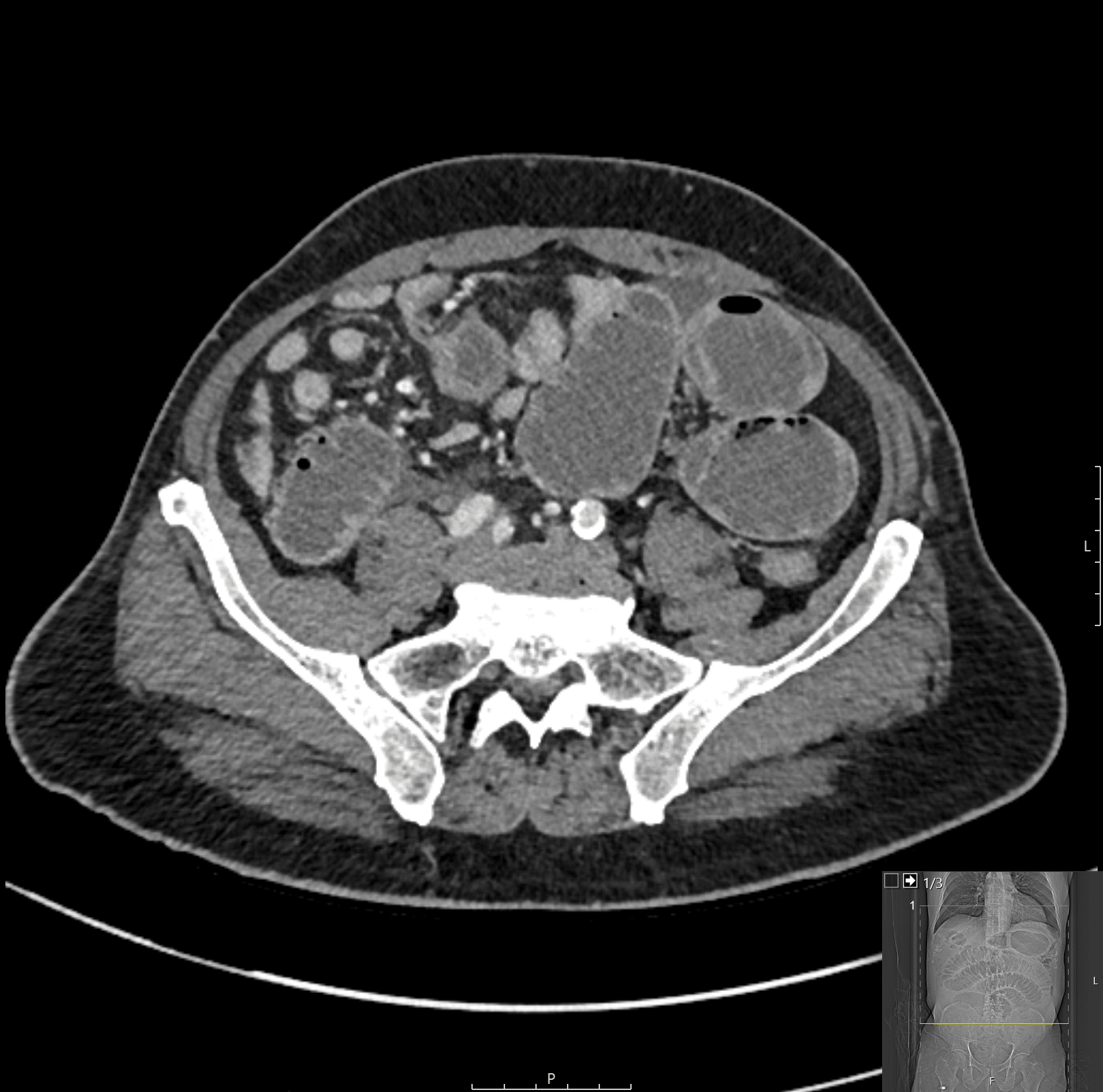 CT Case 066 • LITFL • CT scan interpretation