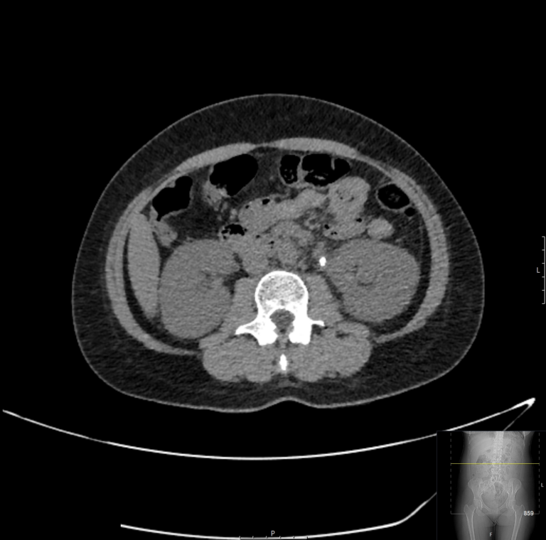 CT Case 067 • LITFL • CT scan interpretation