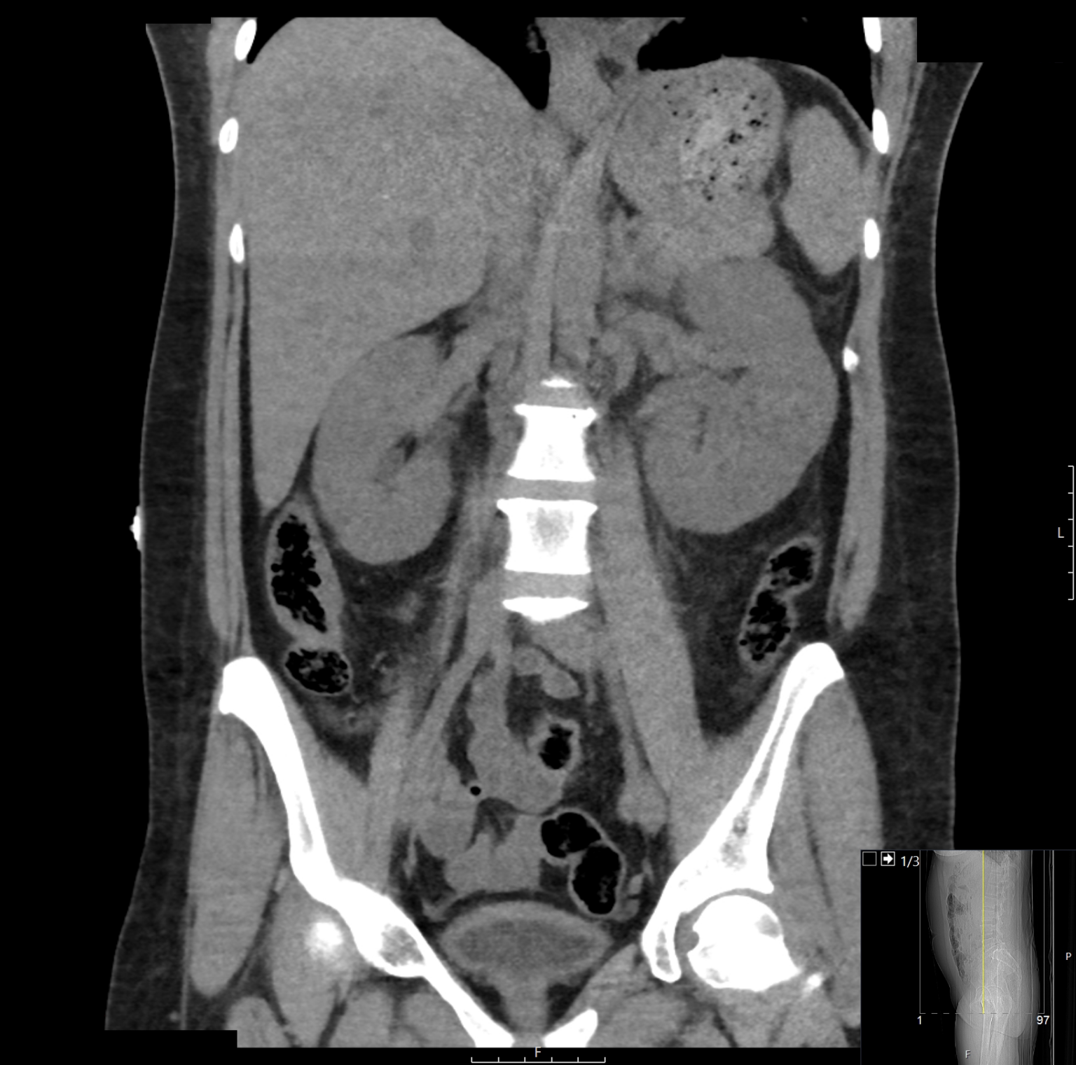 CT Case 067 • LITFL • CT scan interpretation