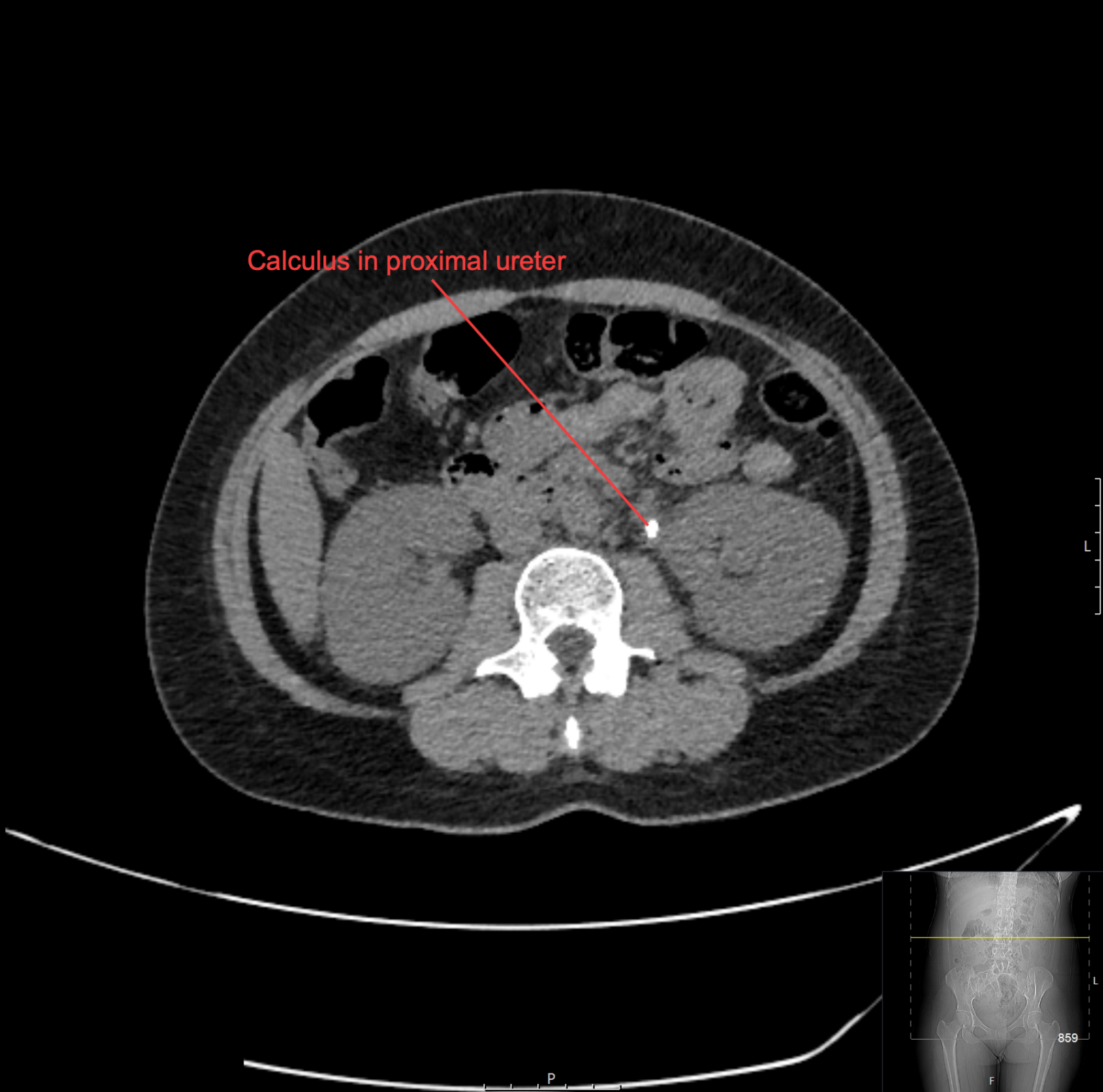 CT Case 067 • LITFL • CT scan interpretation