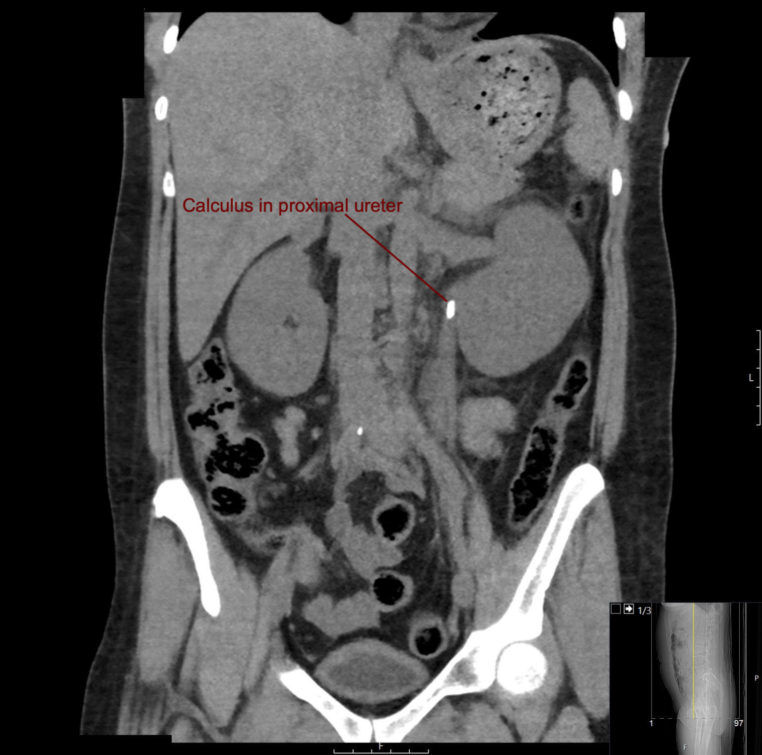 CT Case 067 • LITFL • CT scan interpretation