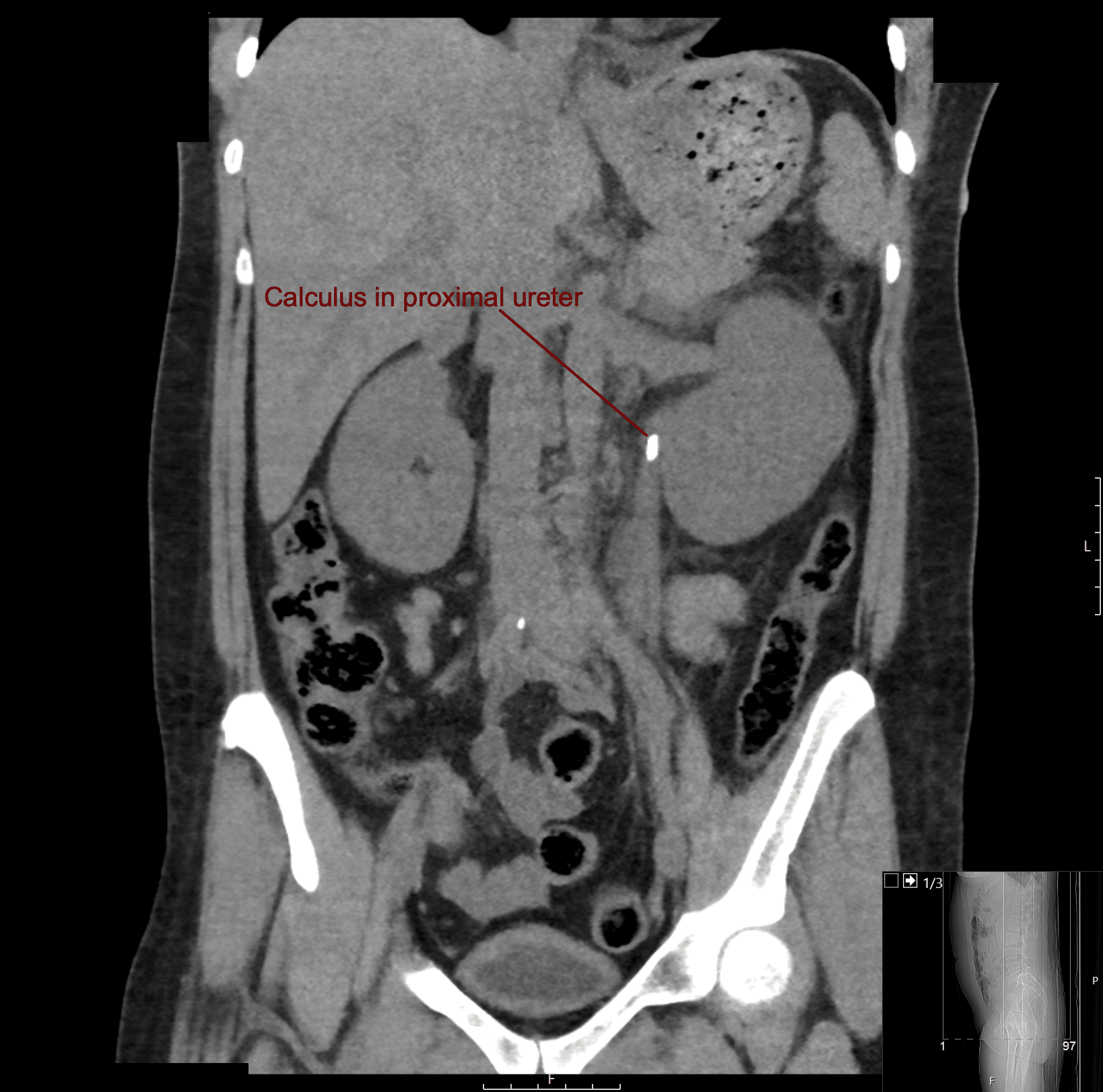 CT Case 067 • LITFL • CT scan interpretation