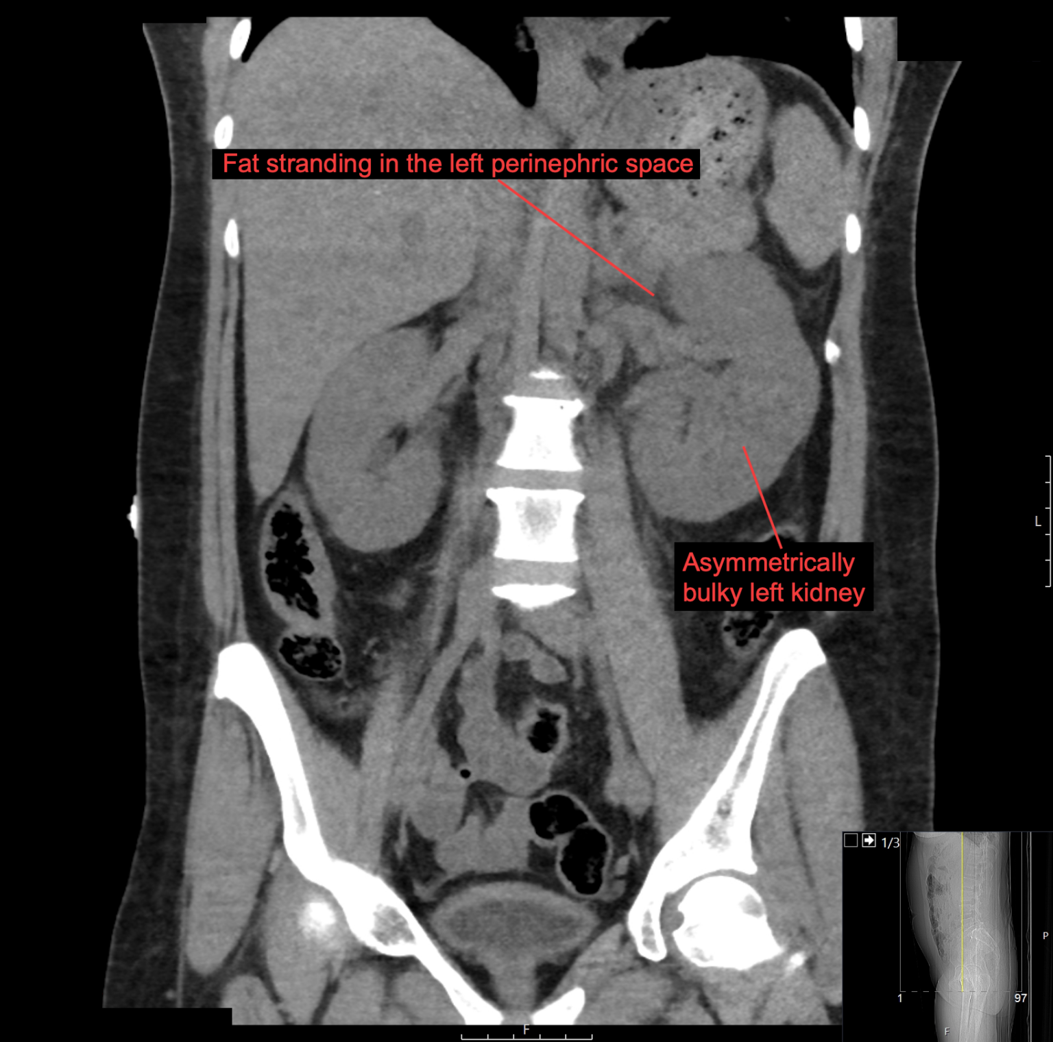 CT Case 067 • LITFL • CT scan interpretation