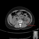 CT Case 067 • LITFL • CT scan interpretation