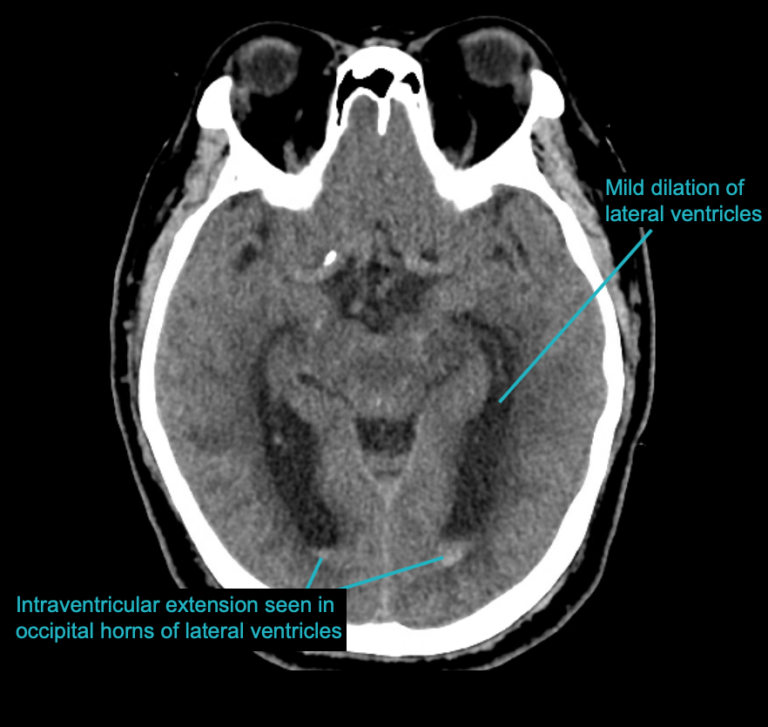 CT Case 088 • LITFL • CT scan interpretation