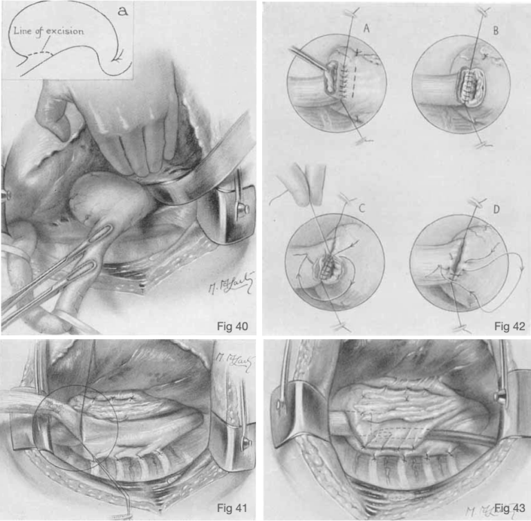 Ivor Lewis • LITFL • Medical Eponym Library
