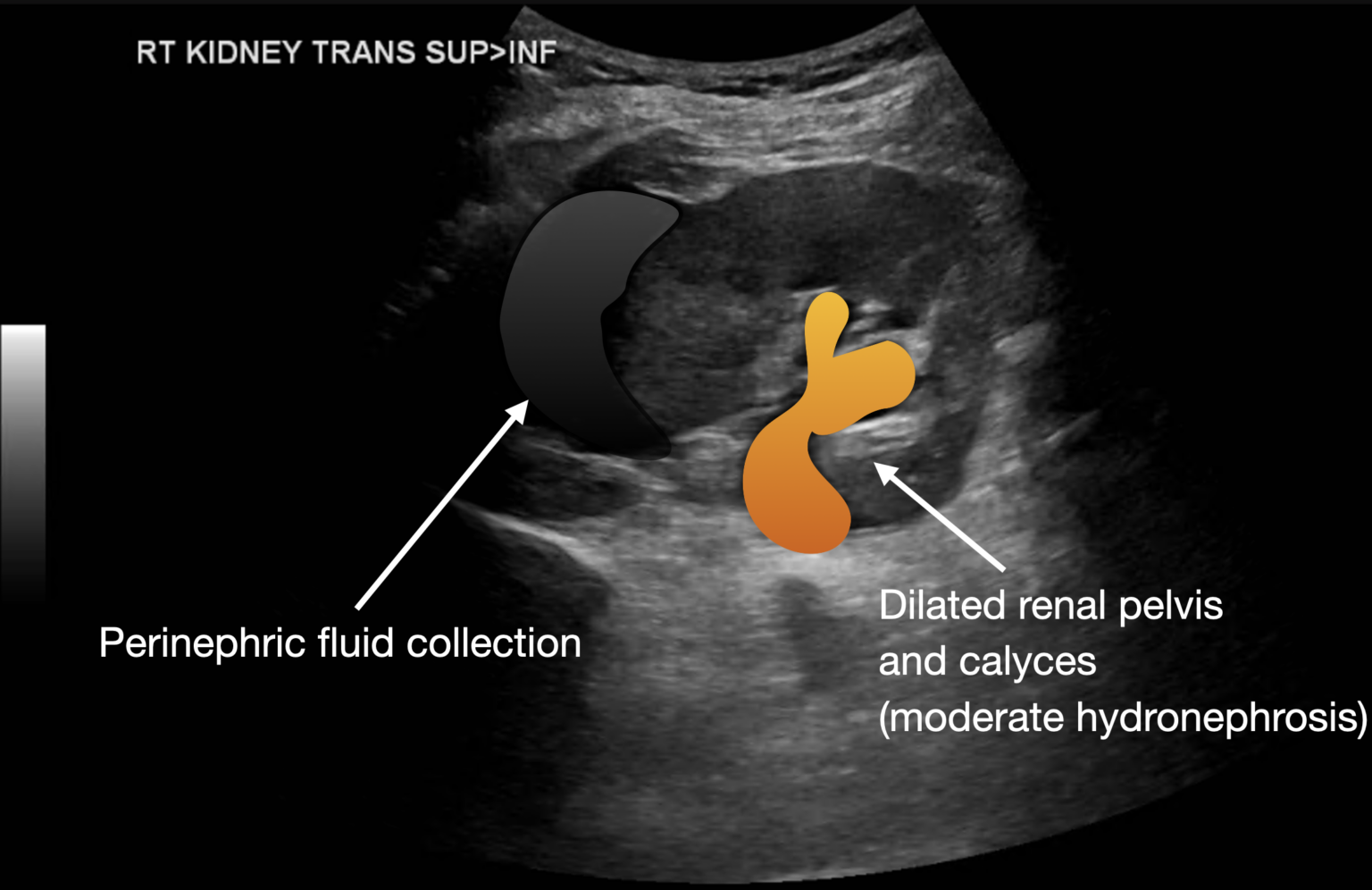 Ultrasound Case 112 • LITFL • POCUS Top 100