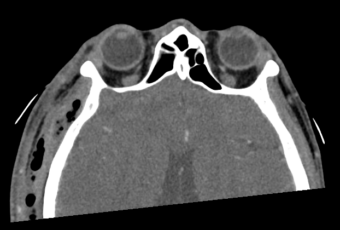 CT Case 068 • LITFL • CT scan interpretation