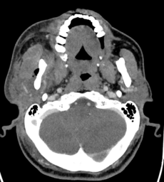 CT Case 068 • LITFL • CT scan interpretation