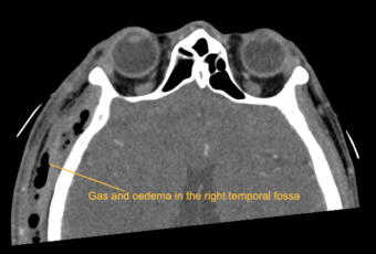 CT Case 068 • LITFL • CT scan interpretation