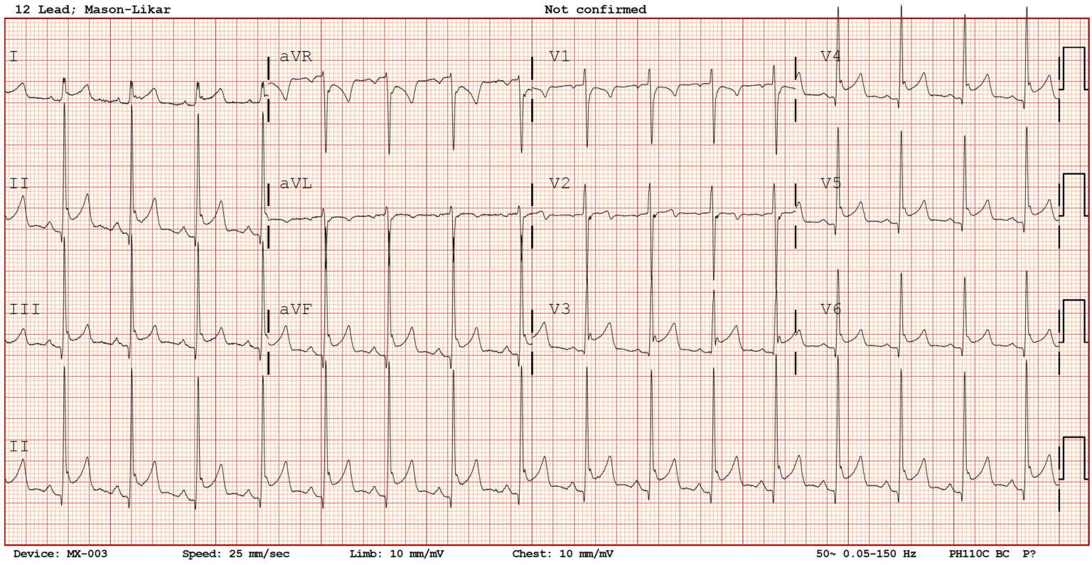 Spodick sign • LITFL • Medical Eponym Library