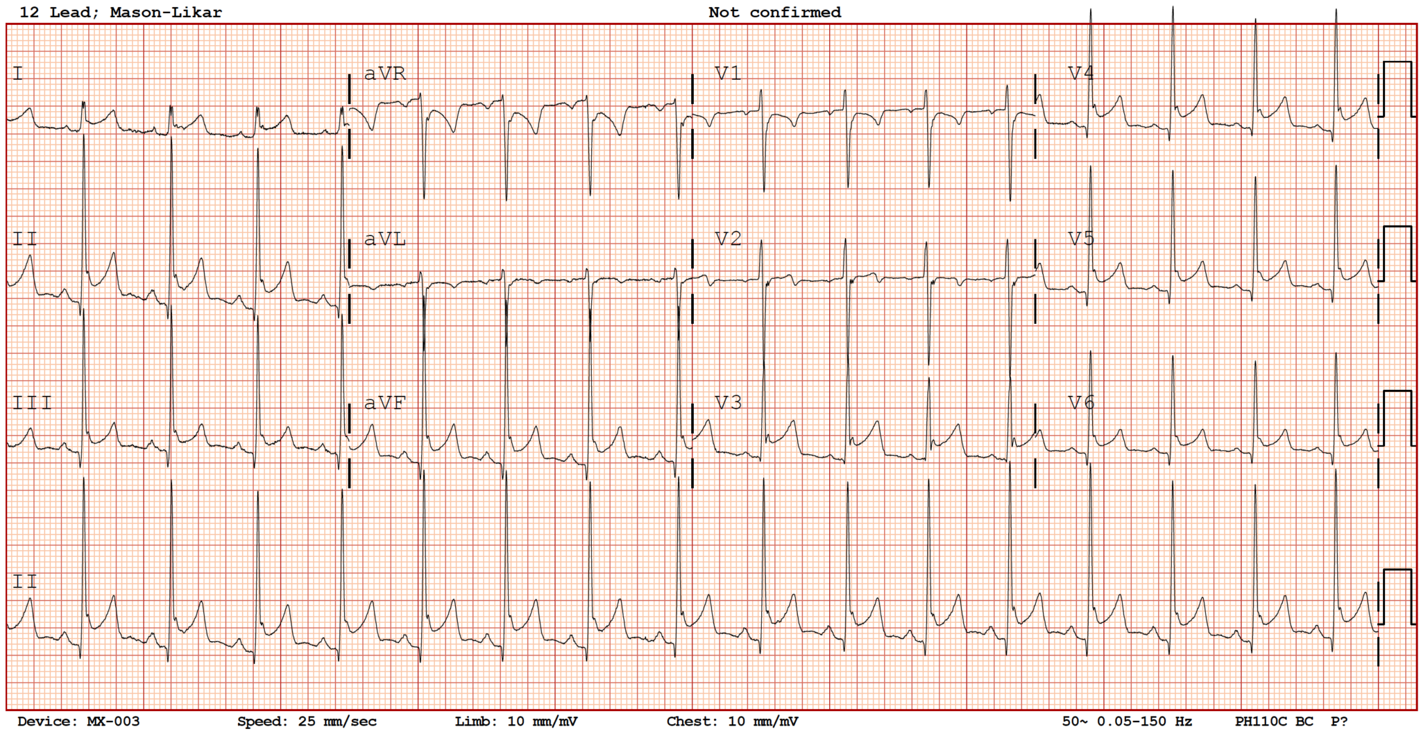 Spodick sign • LITFL • Medical Eponym Library