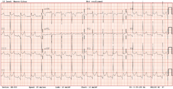 Spodick sign • LITFL • Medical Eponym Library