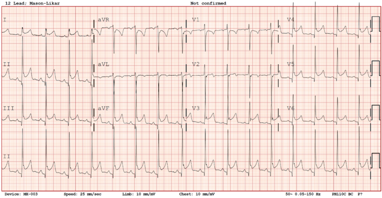 Spodick sign • LITFL • Medical Eponym Library