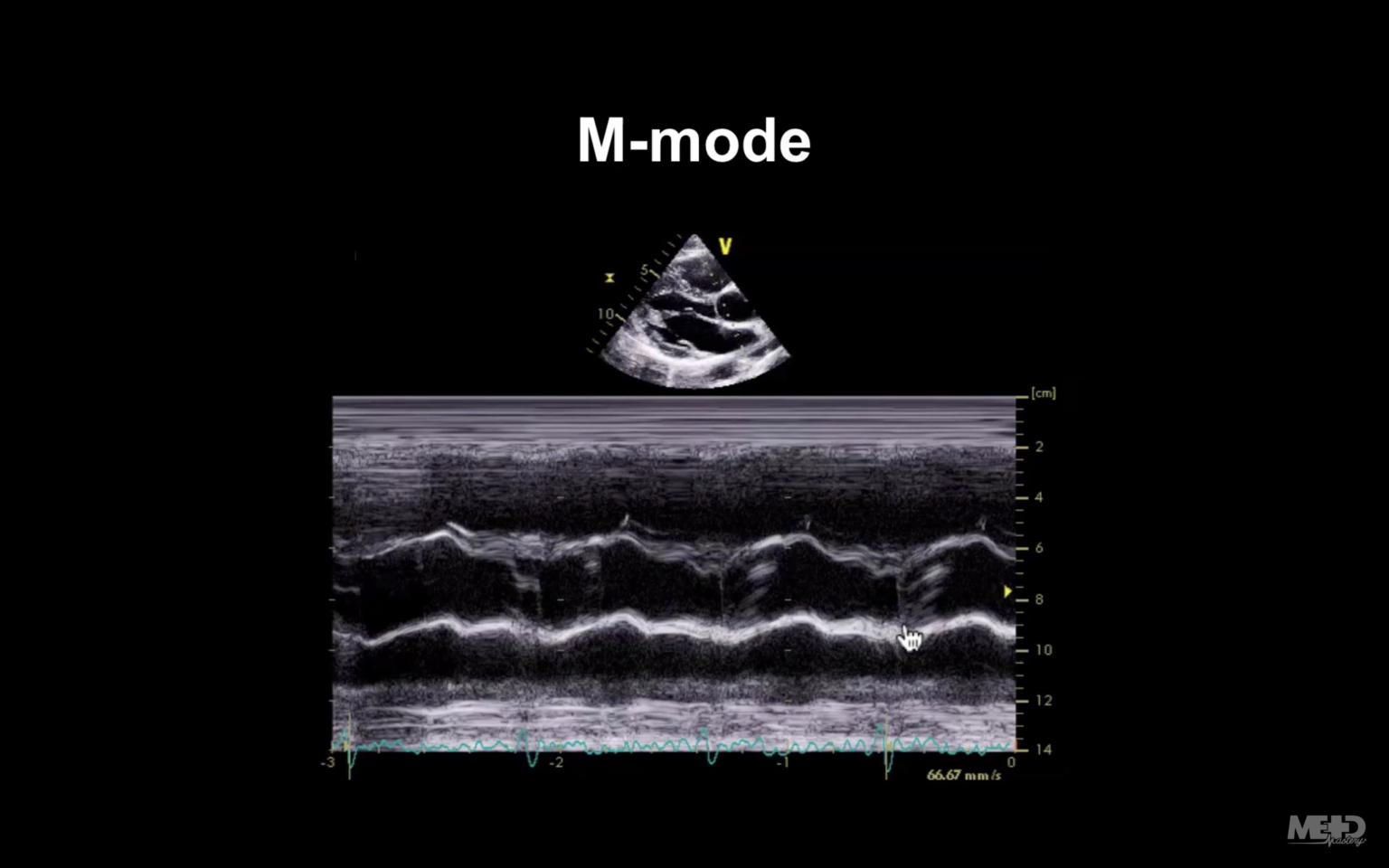 Echo basics: Key concepts • LITFL • Radiology Library