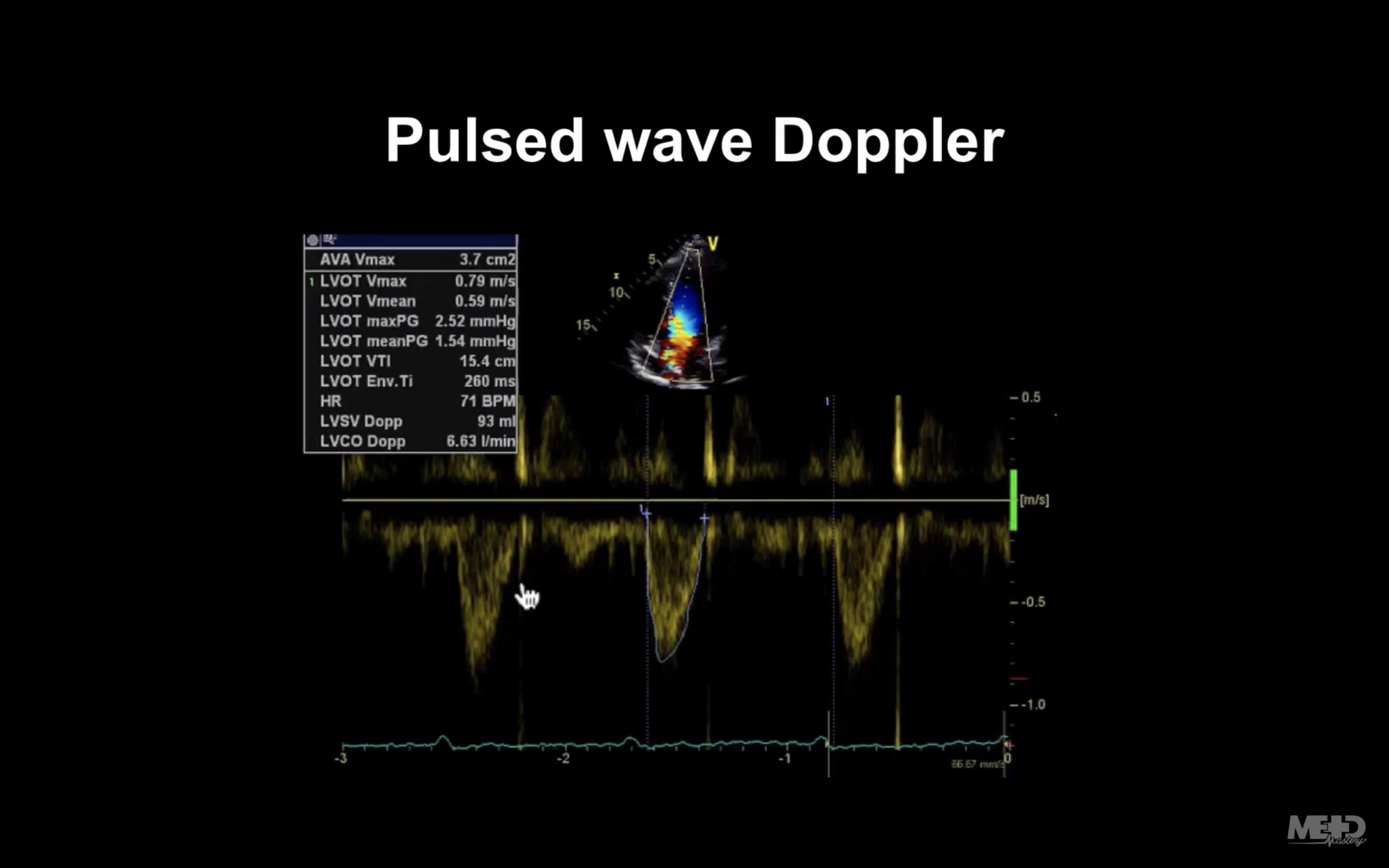Echo basics: Key concepts • LITFL • Radiology Library