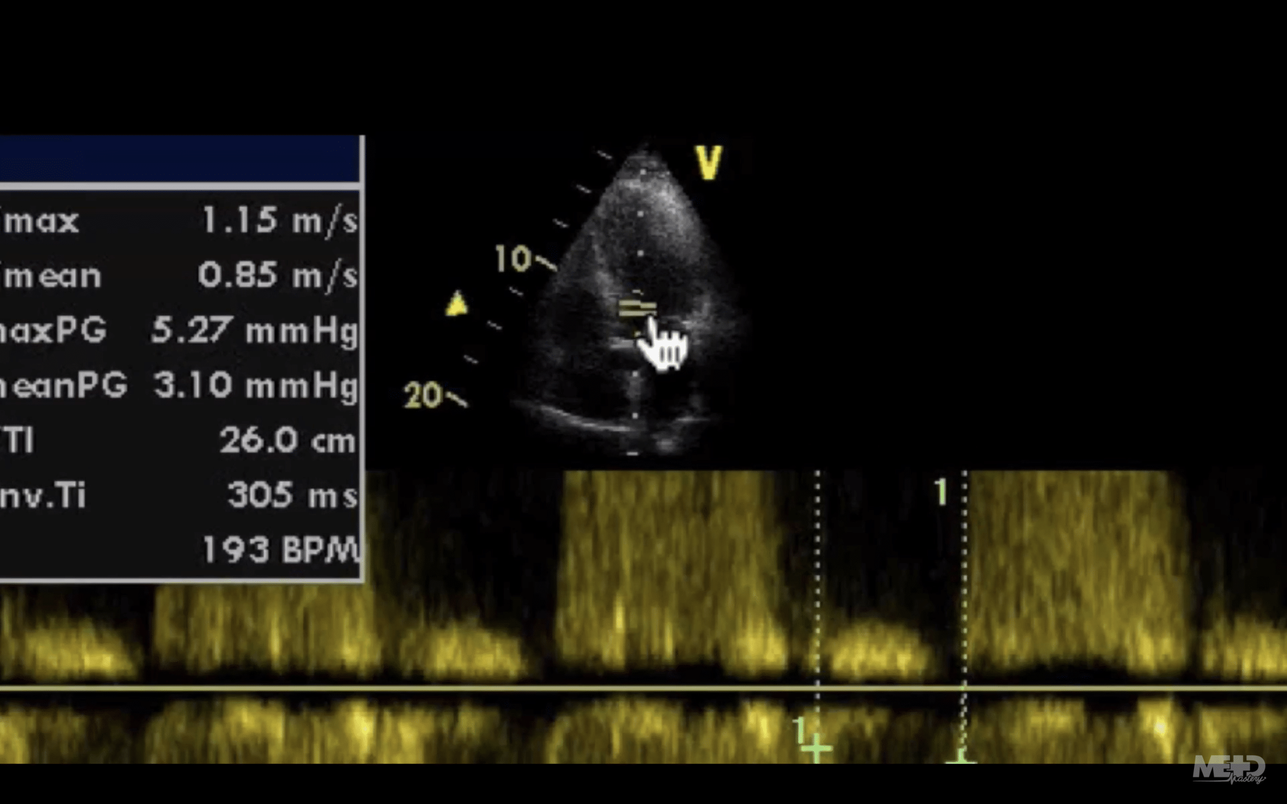 Echo basics: Key concepts • LITFL • Radiology Library