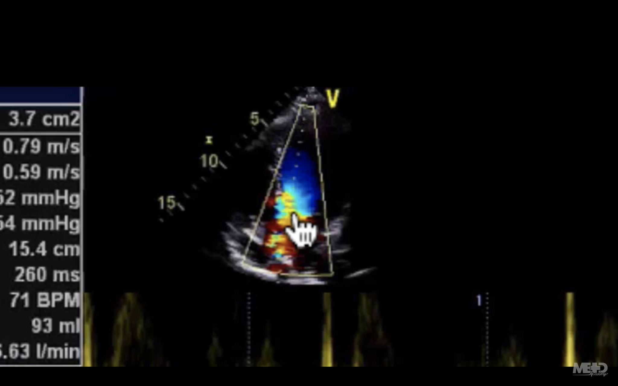Echo basics: Key concepts • LITFL • Radiology Library