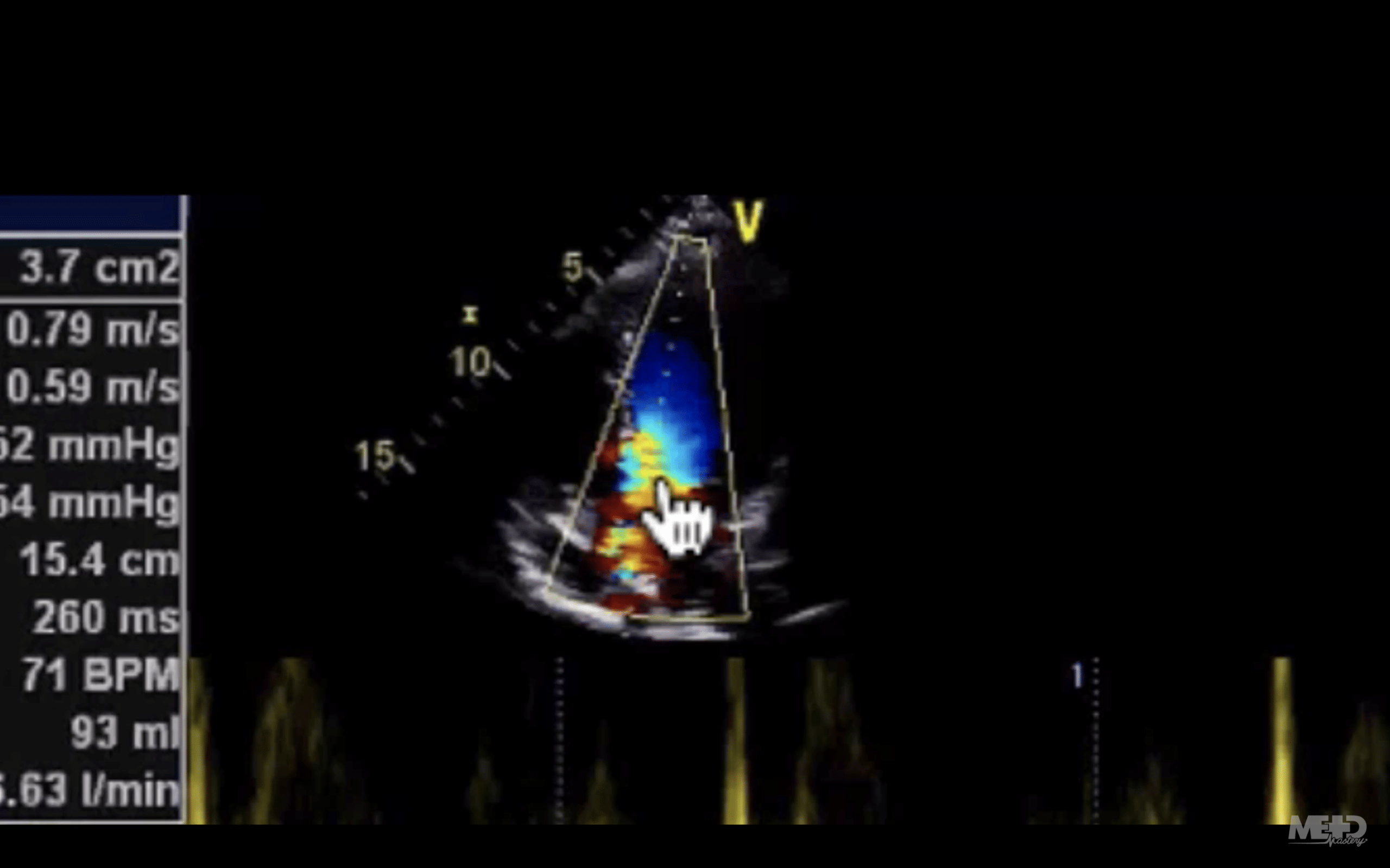 Echo basics: Key concepts • LITFL • Radiology Library