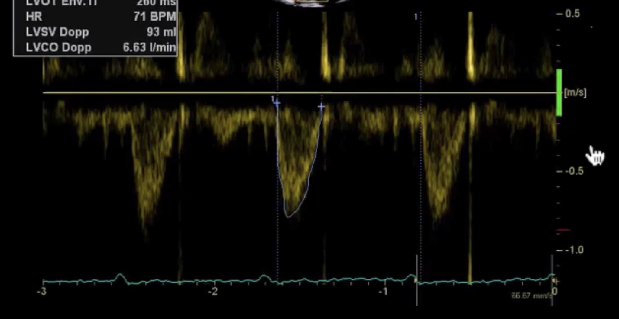 Echo basics: Key concepts • LITFL • Radiology Library