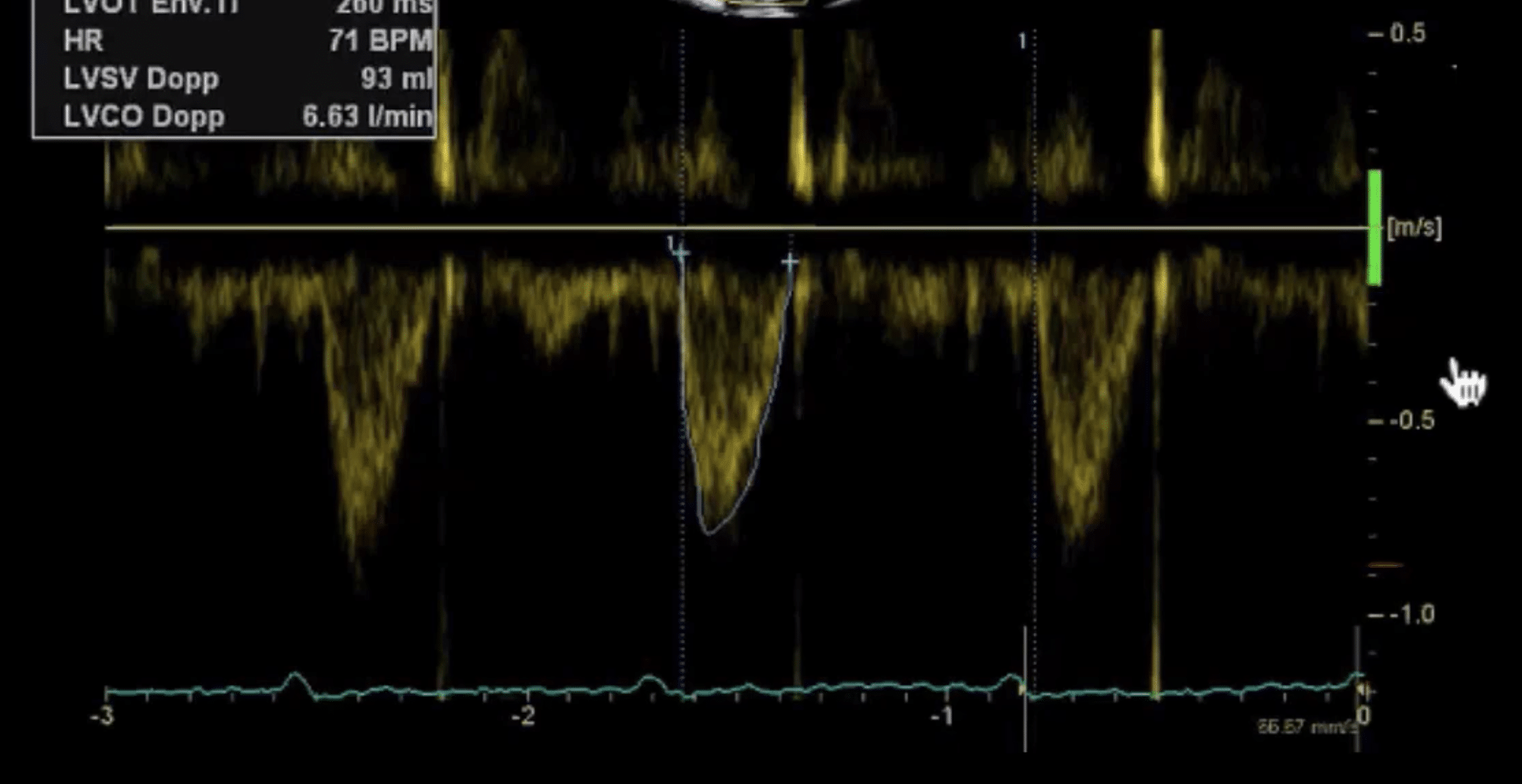 Echo basics: Key concepts • LITFL • Radiology Library