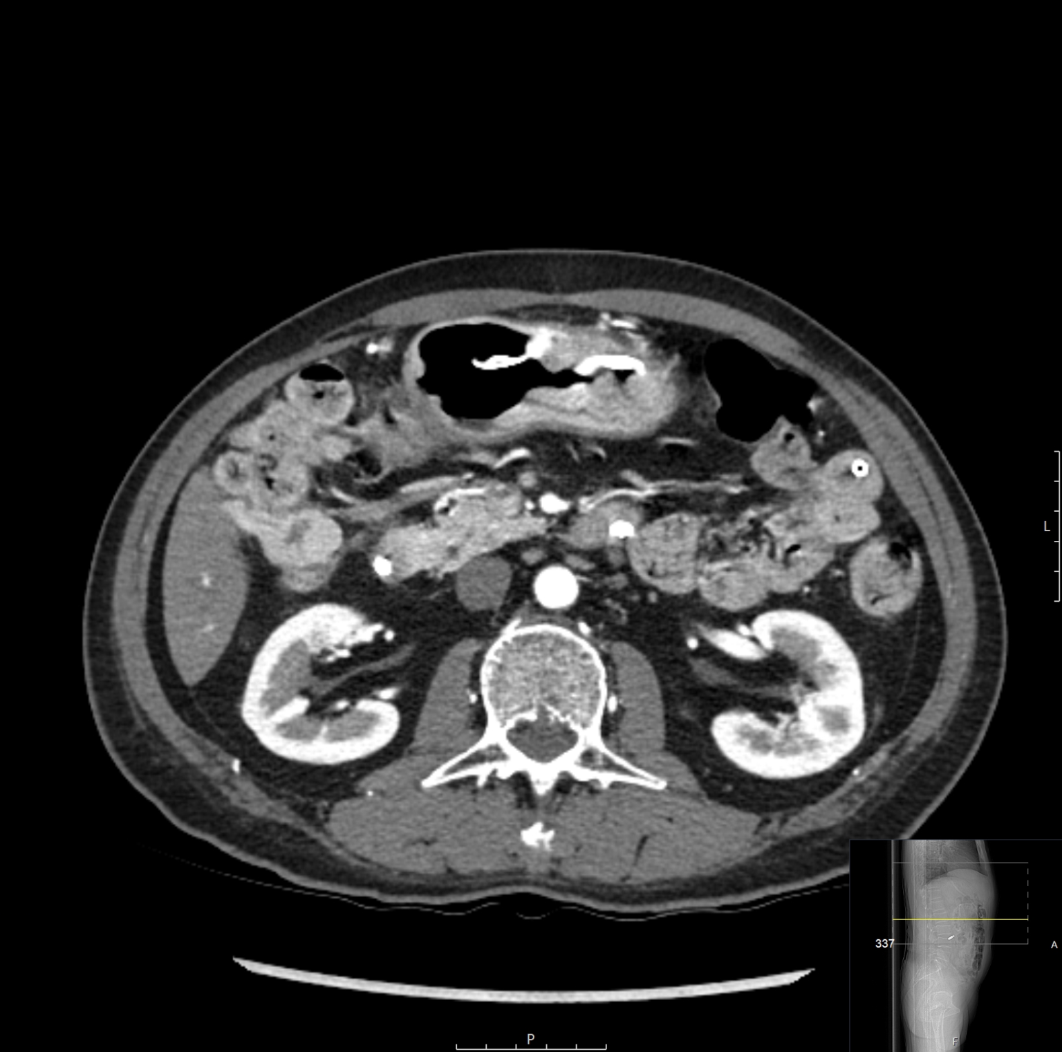 CT Case 069 • LITFL • CT scan interpretation
