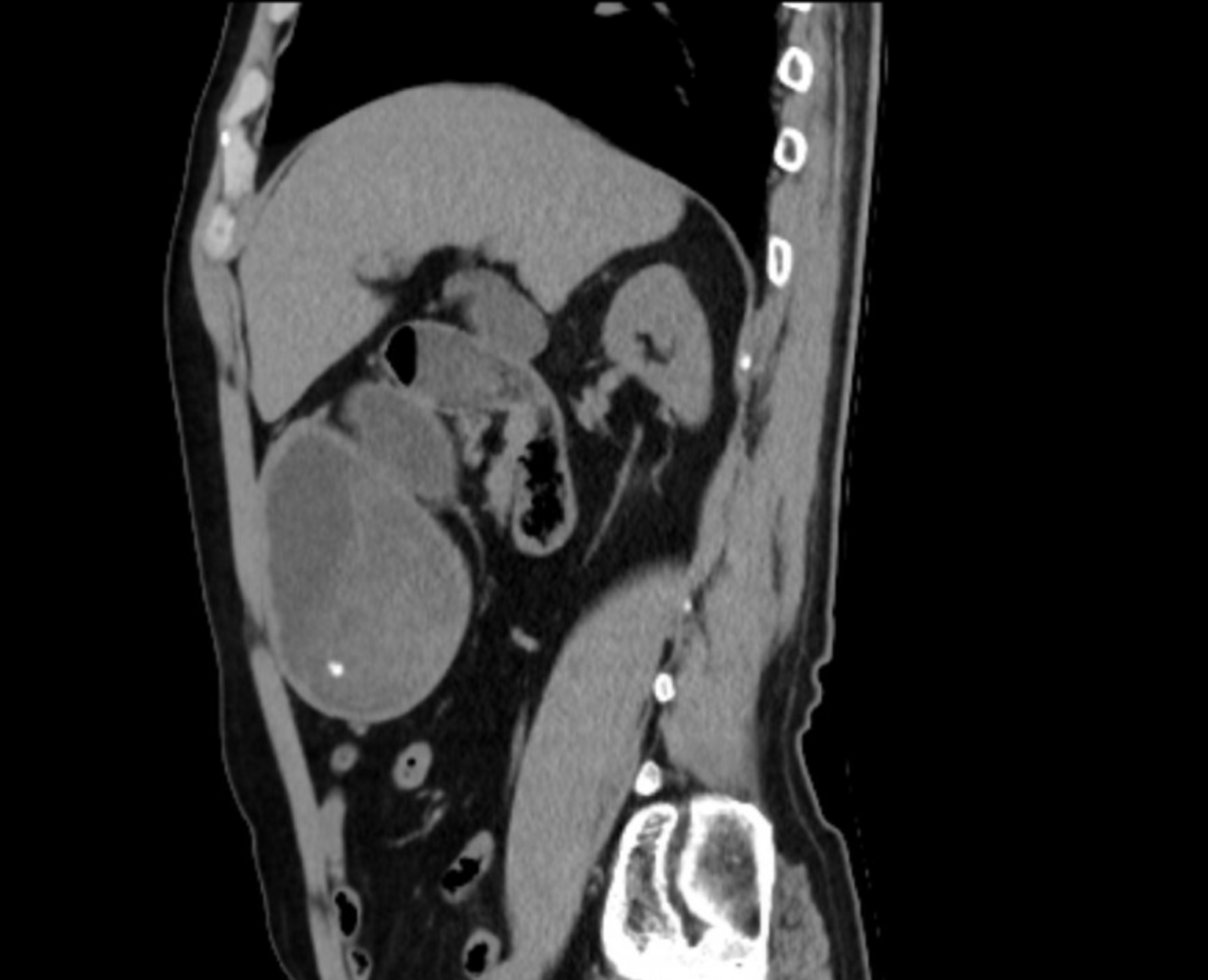 CT Case 069 • LITFL • CT scan interpretation