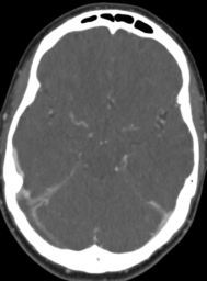 CT Case 071 • LITFL • CT scan interpretation