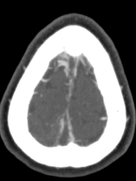 CT Case 071 • LITFL • CT scan interpretation
