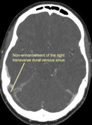 CT Case 071 • LITFL • CT scan interpretation