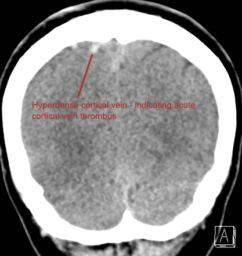 CT Case 071 • LITFL • CT scan interpretation