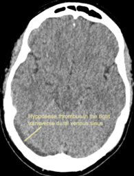 CT Case 071 • LITFL • CT scan interpretation