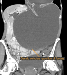 CT Case 072 • LITFL • CT scan interpretation