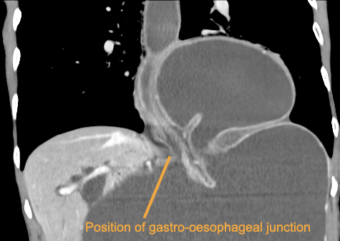 CT Case 072 • LITFL • CT scan interpretation