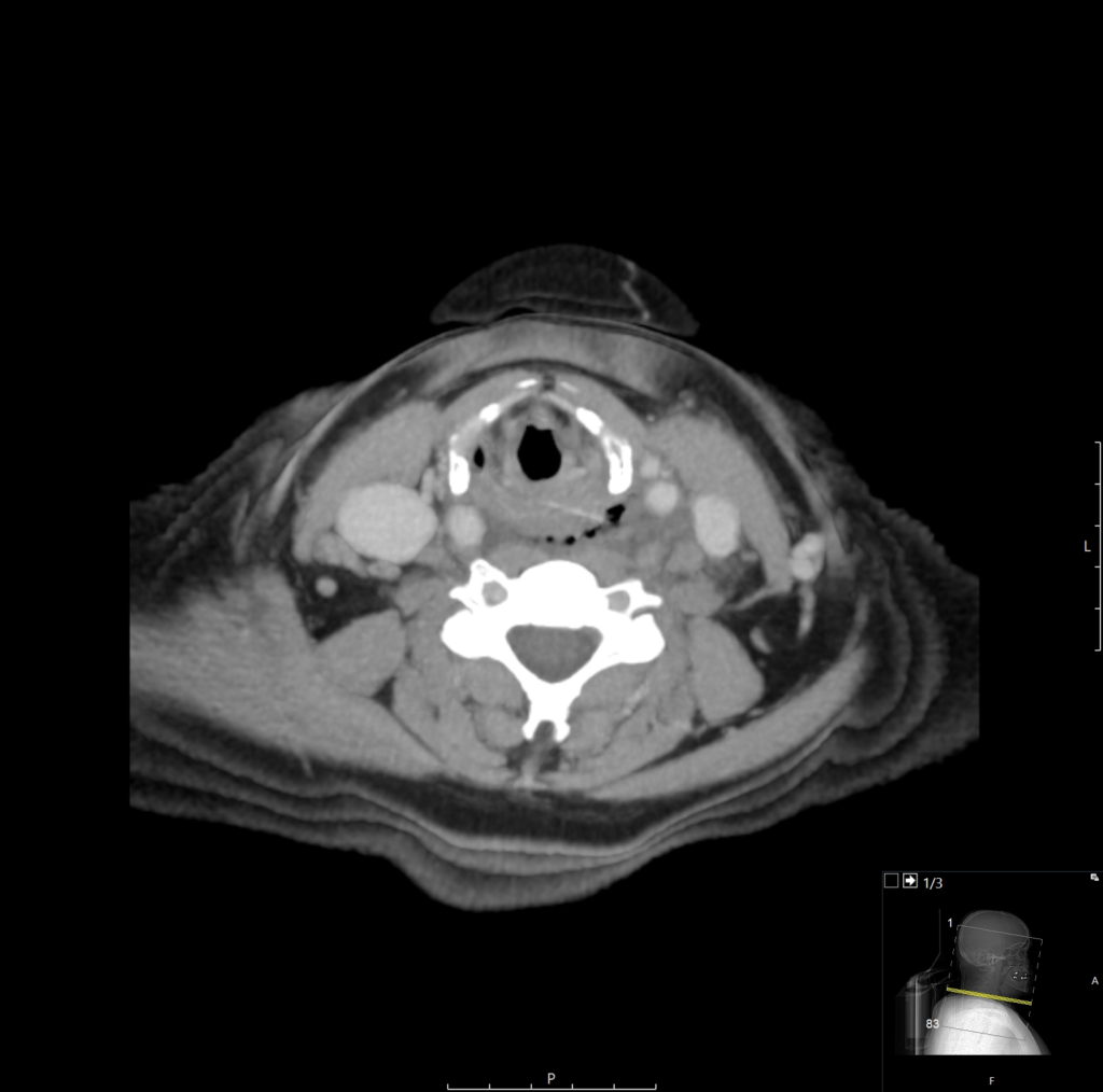 CT Case 076 • LITFL • CT scan interpretation