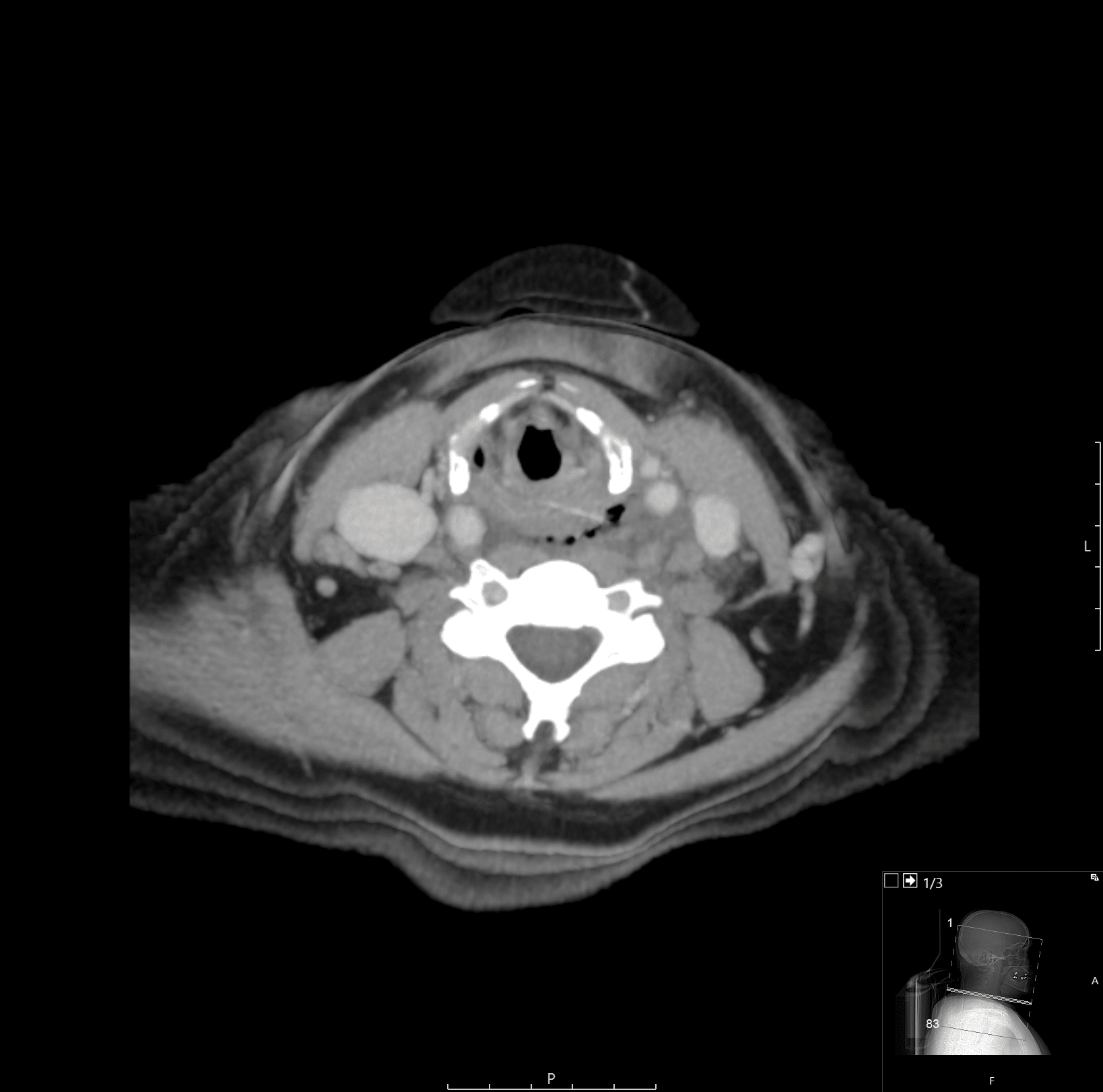 CT Case 076 • LITFL • CT scan interpretation