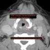 CT Case 076 • LITFL • CT scan interpretation