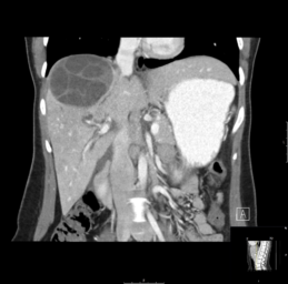 CT Case 077 • LITFL • CT scan interpretation