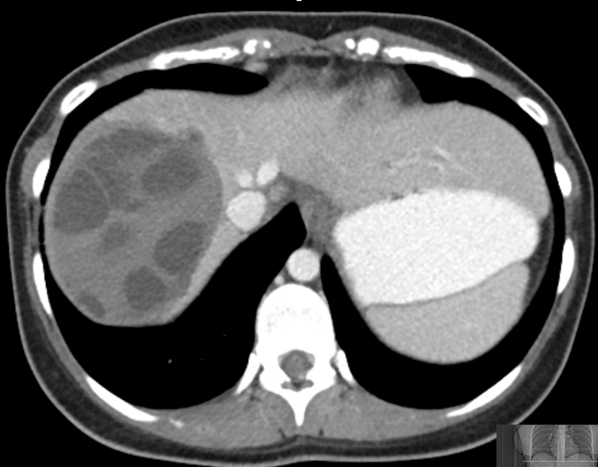 CT Case 077 • LITFL • CT scan interpretation
