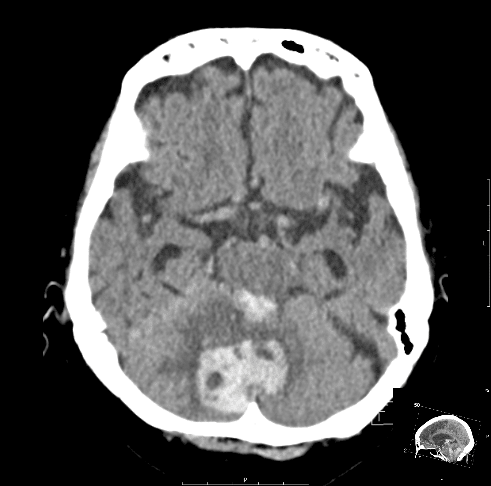 CT Case 078 • LITFL • CT scan interpretation