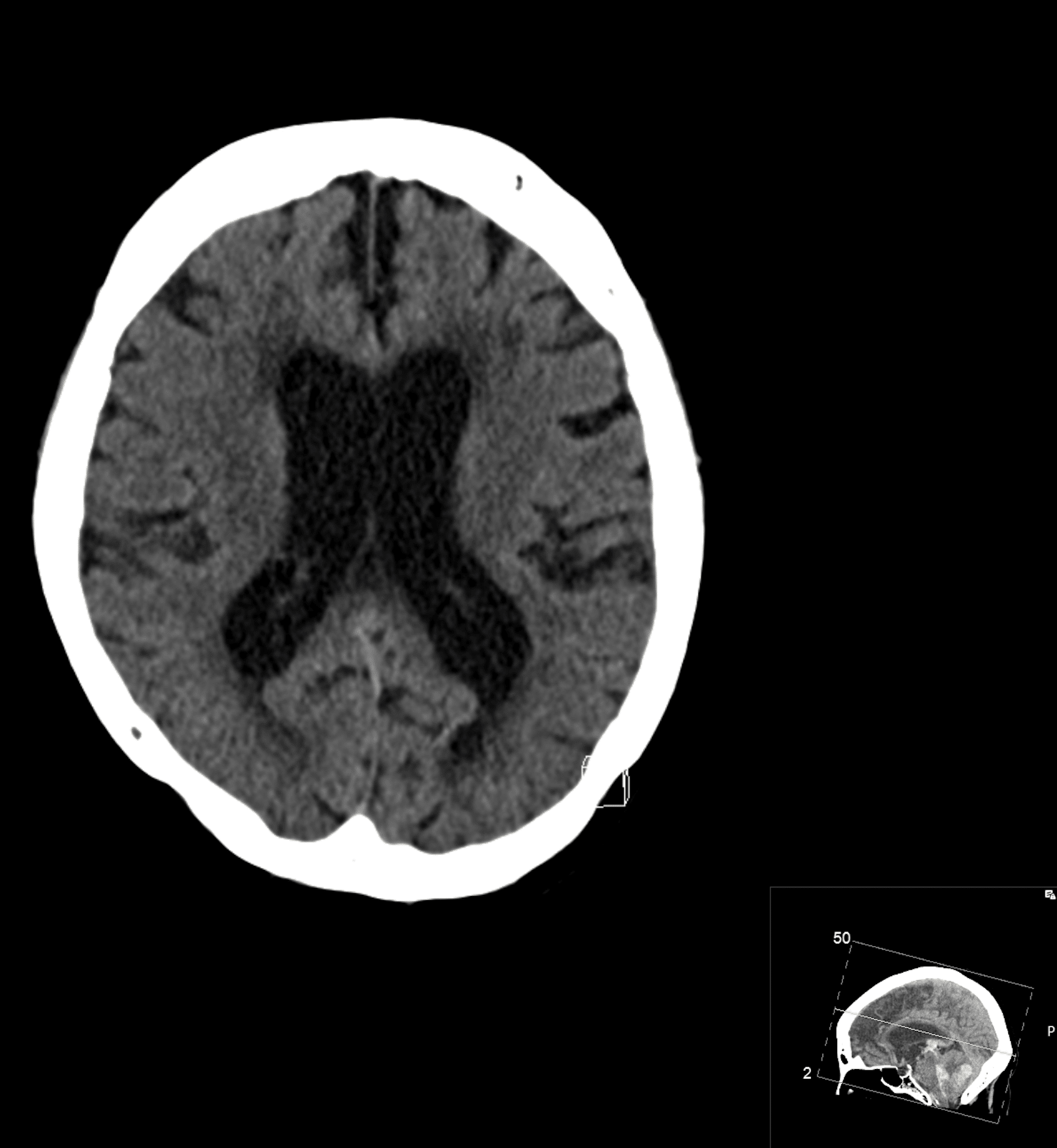CT Case 078 • LITFL • CT scan interpretation