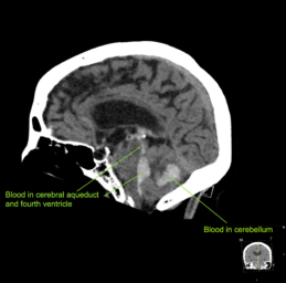 CT Case 078 • LITFL • CT scan interpretation