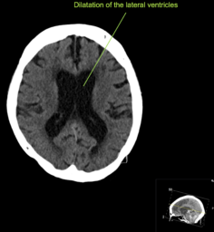 CT Case 078 • LITFL • CT scan interpretation