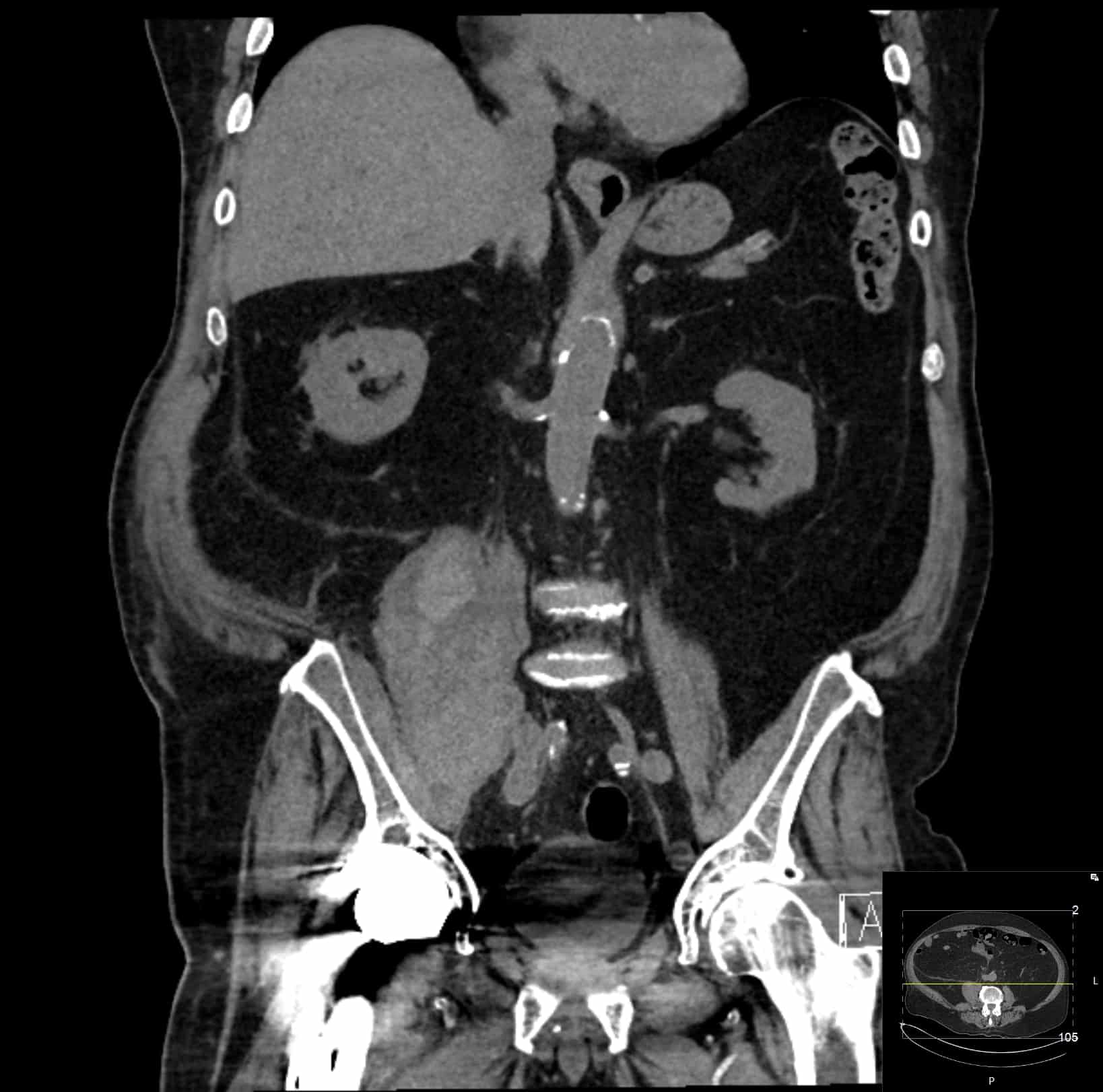 CT Case 080 • LITFL • CT scan interpretation