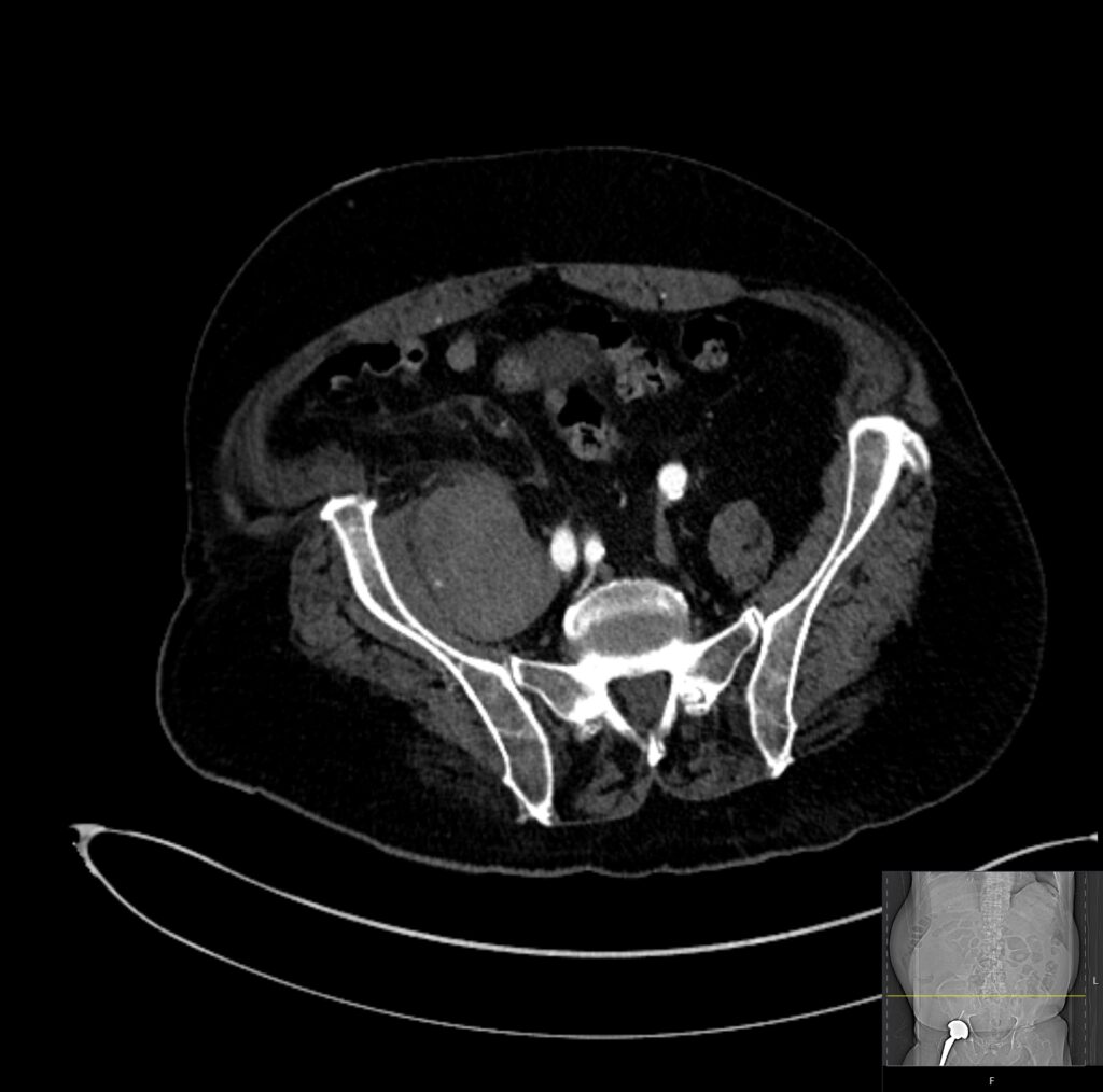 CT Case 080 • LITFL • CT scan interpretation