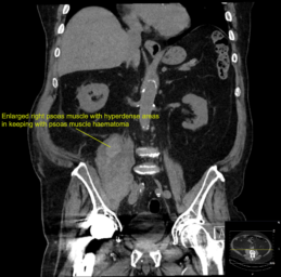 CT Case 080 • LITFL • CT scan interpretation