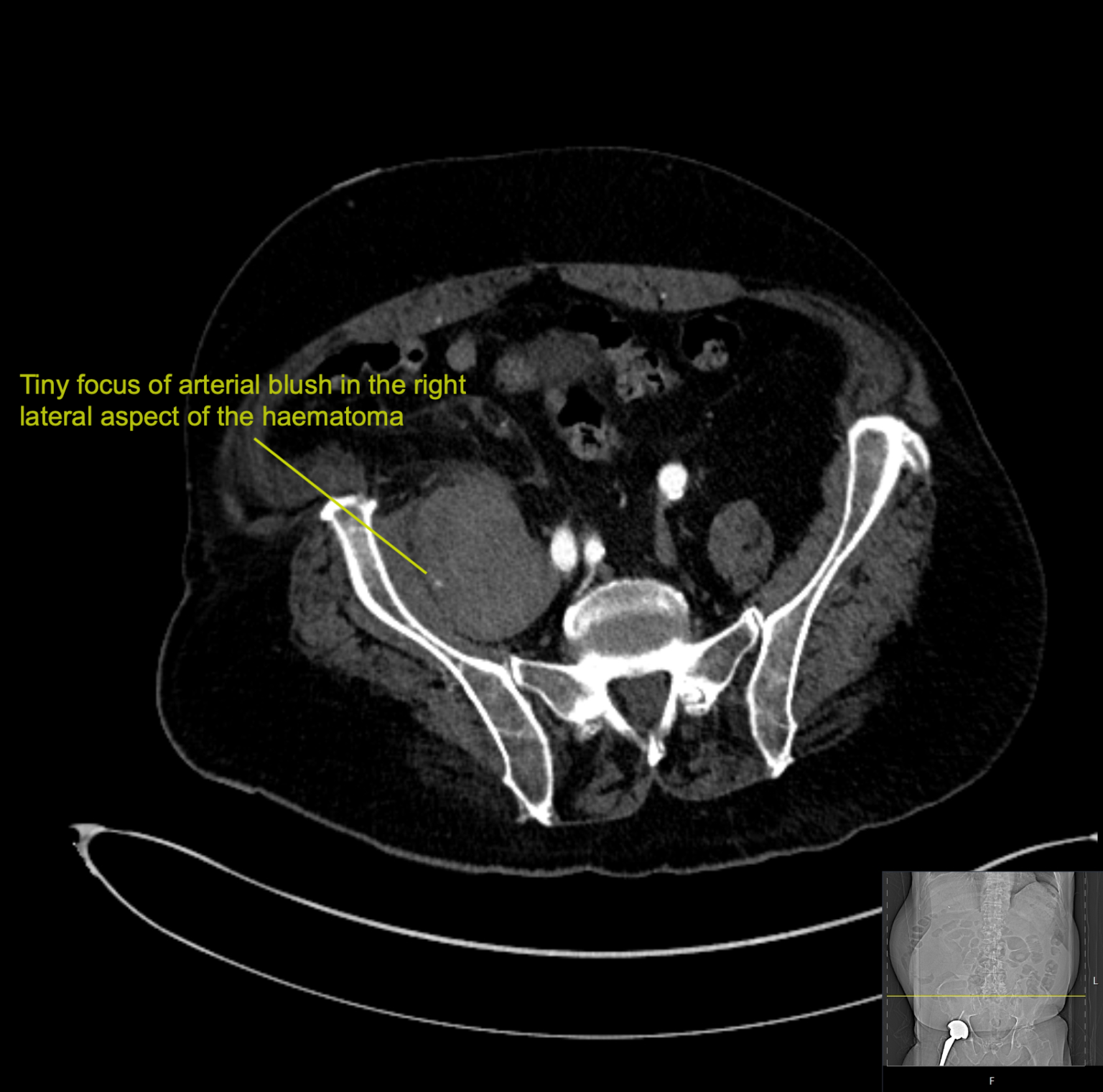 CT Case 080 • LITFL • CT scan interpretation
