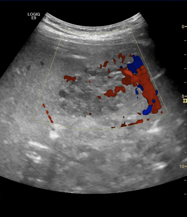 CT Case 081 • LITFL • CT scan interpretation
